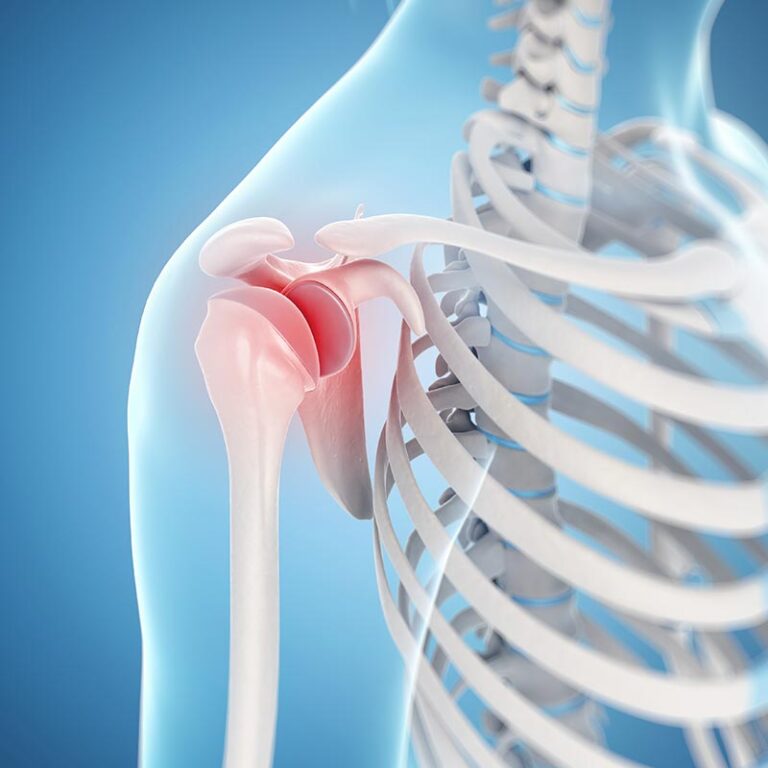 Expert Rotator Cuff pain treatment in Calgary - Divergent Health